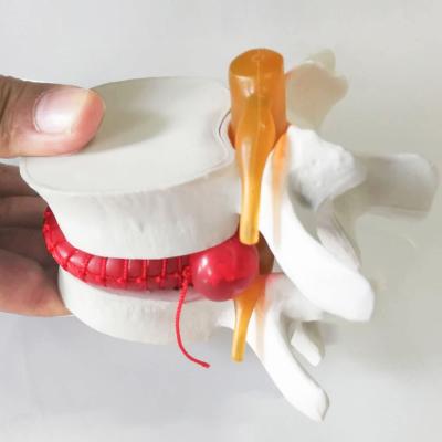 Cina Vertebre 3D Spina cervicale Modello 1.5X Ernia lombare della colonna vertebrale in vendita
