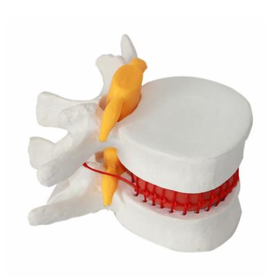 Cina Vertebre 3D Spina cervicale Modello 1.5X Ernia lombare della colonna vertebrale in vendita