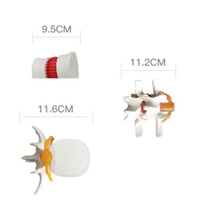 Cina Vertebre 3D Spina cervicale Modello 1.5X Ernia lombare della colonna vertebrale in vendita