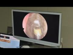 Radio Frequency Plasma Surgery System for ENT Surgery Coblator II