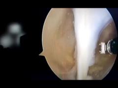 Dispositivo cirúrgico criogênico do tratamento ortopédico de alta frequência do sistema da cirurgia do plasma