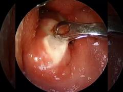 15cm Length Diagnostic Ent Plasma Probe for Perforation Applications