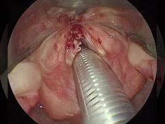 Minimally Invasive ENT Surgical Instruments Working Mode with Coagulation level 1-10