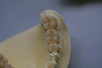 China Het Zirconiumdioxyde Tandkroon van het zirconiumdioxydeporselein met Ceramisch Te koop