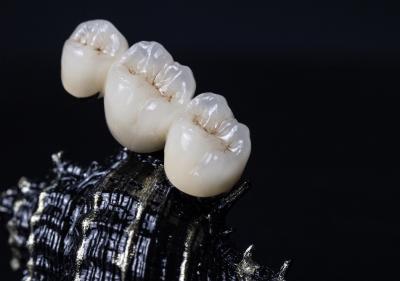 China De Tandkroon van het metaalkader PFM Te koop