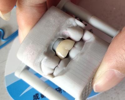 Cina Corona dentaria della corona 3D del laboratorio PFM del ponte dentario di stampa in vendita