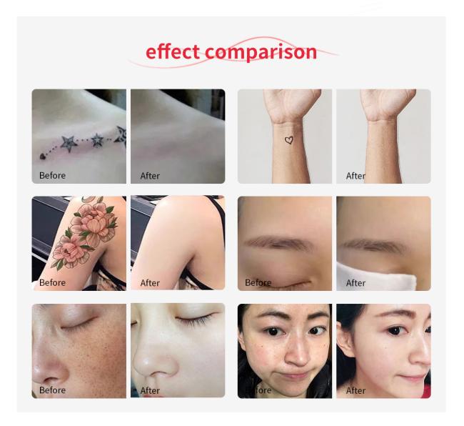 Newest picosecond laser Q switch ND YAG laser tattoo pigment removal treatment machine