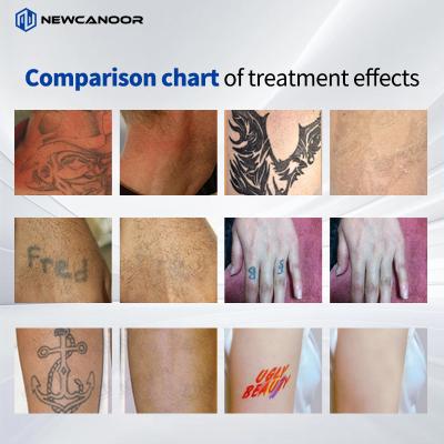 Cina Q Switch Tattoo Removal Nd Yag Laser Machine 1064nm 532nm 755nm 1320nm in vendita