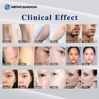 China DPL Permanent Hair Removal Machine Facial Body Skin Painless Hair Removal Device for sale