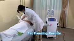 Professional fat freezing therapy session