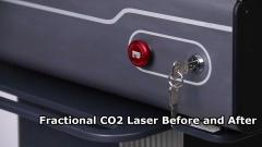 Fractional CO2 Laser Before and After – Real Results