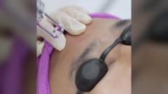 How to operate picolaser tattoo removal machine