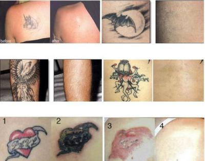 China 2016 High quality Q switch nd yag tattoo removal laser machine  for sale