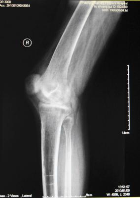 China KND-A Low Fog Medical Dry Imaging Film For X Ray Examination On AGFA 5300, 5302, 5500 for sale