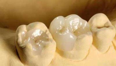 China Composite Resin Restoration for Dental Restorations for sale