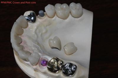 China Porcelain Dental Crown Tooth-Shaped Cap for Restoring Shape and Enhancing Appearance for sale