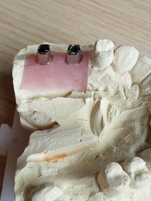 China Titanium Abutment for sale