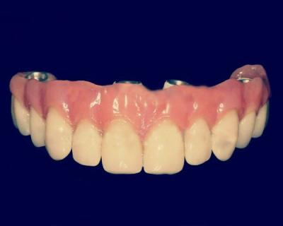 China Implant-Supported Bar Attachment in Titanium or Cobalt-Chromium Alloy for Even Force Distribution and Customizable Design for sale