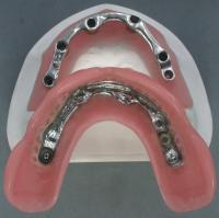 China Implant-Supported Bar Attachment in Titanium or Cobalt-Chromium Alloy for Even Force Distribution and Customizable Design for sale