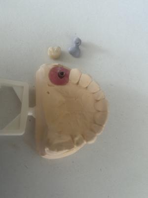 China Full Zirconia Cement Retained Abutment for Implant-Supported Dental Restorations for sale