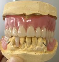 China Full Arch Denture for sale