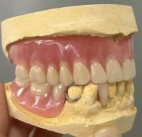 China Full Arch Denture for sale