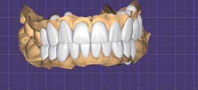 China Precision Fit Digital Wax Up Dental Study Model with Durable and Biocompatible 3D Printed Design for sale
