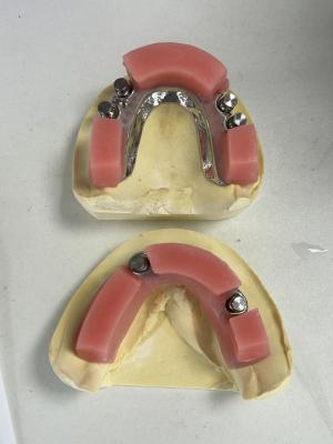 China Steel Framework Implant Denture with High-Quality Cobalt-Chromium Alloy for Biocompatible and Corrosion Resistant Digital Design Precision Casting for sale