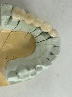 China Cobalt Chrome PFM Crown for sale