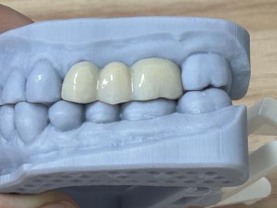 China Composite Veneers & Dental Veneers with Customized Shade, Natural Tooth-Like Appearance for Conservative Restoration for sale