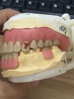 China Customized Gold Teeth with Removable Denture for sale