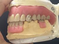 China Customized Gold Teeth with Removable Denture for sale