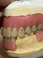 China Customized Gold Teeth with Removable Denture for sale