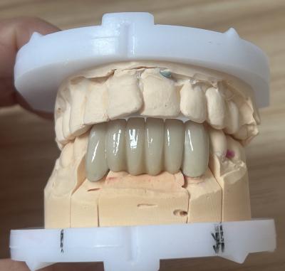 China Cobalt-Chromium Alloy Porcelain-Fused-to-Metal Dental Bridge with Natural Tooth-Colored Porcelain Customized to Patient-Specific Dental Requirements for sale