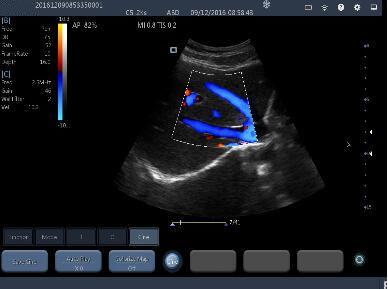 Portable Ultrasound Machine Probes Wireless Ultrasound Probe with 2~11MHz Frequency 160g Weight Only