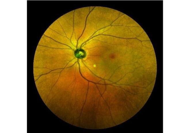 attrezzatura oftalmica Ultra di ampiezza di Angiograph Digital della retina di esame del laser del campo con lo zoom ottico 100°/60°/30°