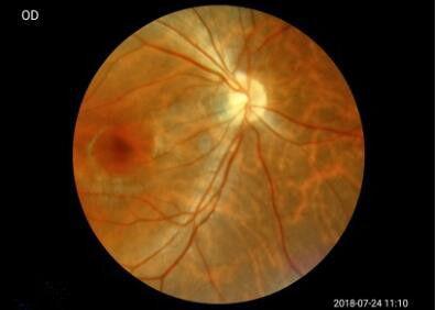 Android System For Easier Operation Hand-held Fundus Camera With Minimum Pupil 2.5mm Image Resolution 1920x1080