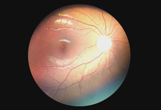 Resolution 2560 X 1920 Pixels Digital Fundus Camera 40° Manual Focus Portable Fundus Camera