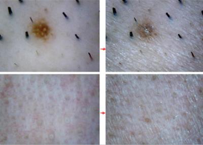 Cina Video analizzatore intelligente facciale astuto della pelle dell'umidità HD della macchina fotografica della pelle di Dermatoscope in vendita
