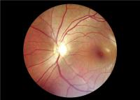 China Handheld Digital Fundus Camera for sale