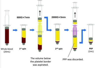China Kit PRP for PRP centrifuges platelet rich plasma  disposable syringe Brushless motor en venta