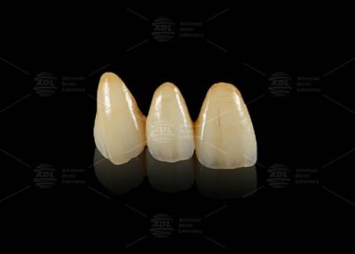 Durable Hypoallergenic EMAX Bridge Extreme Esthetics Emax Dental Bridge