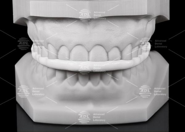Quality Breathable Nylon Occlusal Splint for Nighttime Teeth Grinding Comfortable and for sale