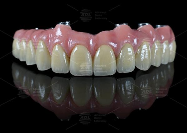 Quality China Dental Lab Hybrid Bridge Implant Bar Malong Design Screw retained Or Cemented Installation Method For Precision Dental Applications for sale