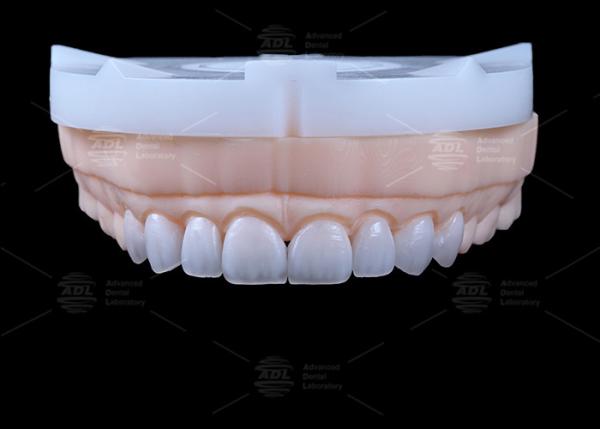 Quality China Dental Lab Over 13 Years In Dental Lab Industry Providing Emax Veneer 16 Shades To Meet Diverse Dental Restoration Needs for sale
