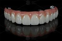 Quality China Dental Lab Fast Turnaround Time In 72 Hours Provides High Quality All on X for sale