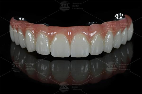 Quality China Dental Lab Fast Turnaround Time In 72 Hours Provides High Quality All on X for sale