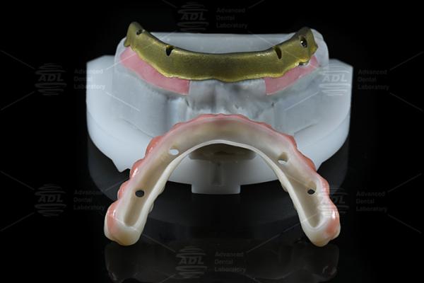 Quality China Dental Lab Compatible With Most Dental Implant Systems All on 4 Offering In 72 Hours Turnaround Time And Array Technical Parameters for sale