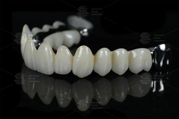 Quality China Dental Lab Outsource Dental Lab Ti Reinforcement Bar With Full Zirconia Providing Competitive Pricing With Volume Discounts Tailored To Dental Professionals Requiring And Manufacturing for sale