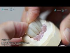 screw retained titanium custom abutment porcelain fused to zirconia